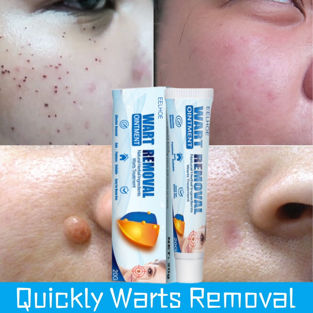 Warts Removal Cream Ubat Ketuat Tapak Kaki Wart Remover Skin Tag ...