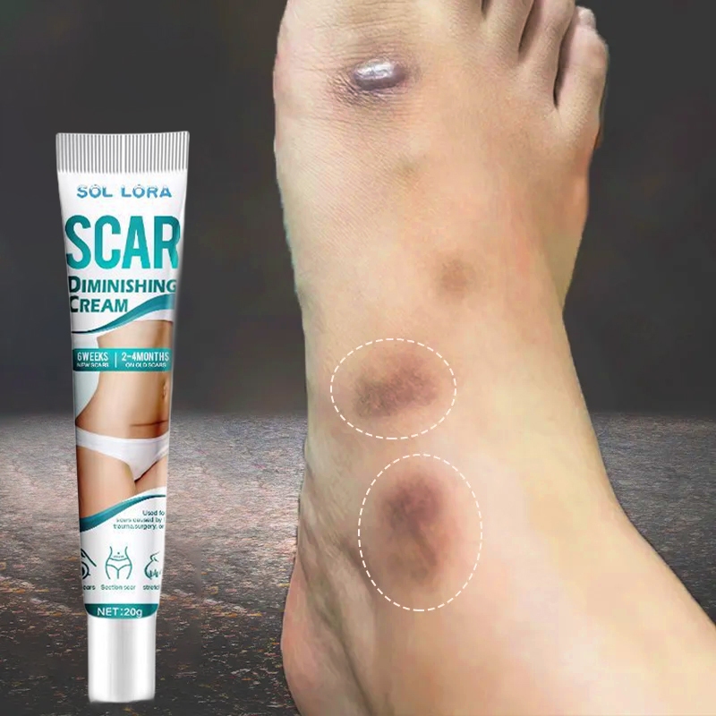 krim hilangkan parut hitam Menghilangkan bekas luka lama Ubat parut ...