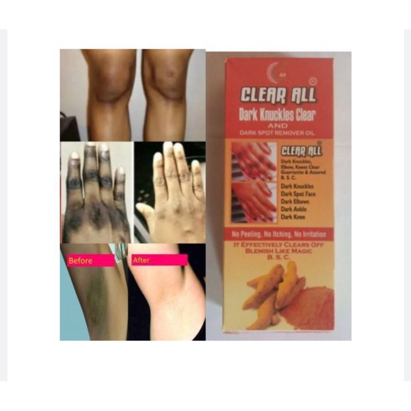 Clear All Dark Knuckles Clear And Dark Spot Remover Oil | Shopee Malaysia