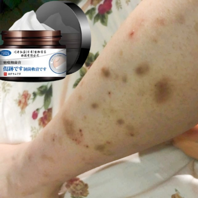 krim hilangkan parut hitam Hilangkan parut kaki Menghilangkan bekas ...