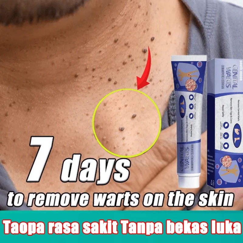 Warts Remover Original Cream Warts and Skin Label Remover Warts Remover ...