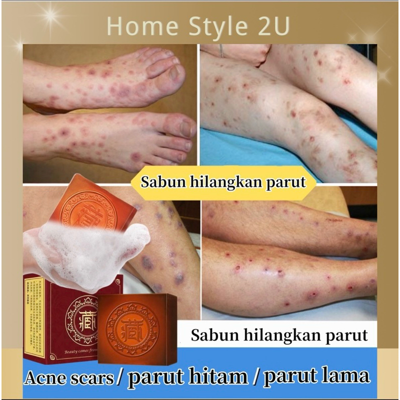 Sabun hilangkan parut Sabun hilangkan parut kudis Sabun parut kaki ...