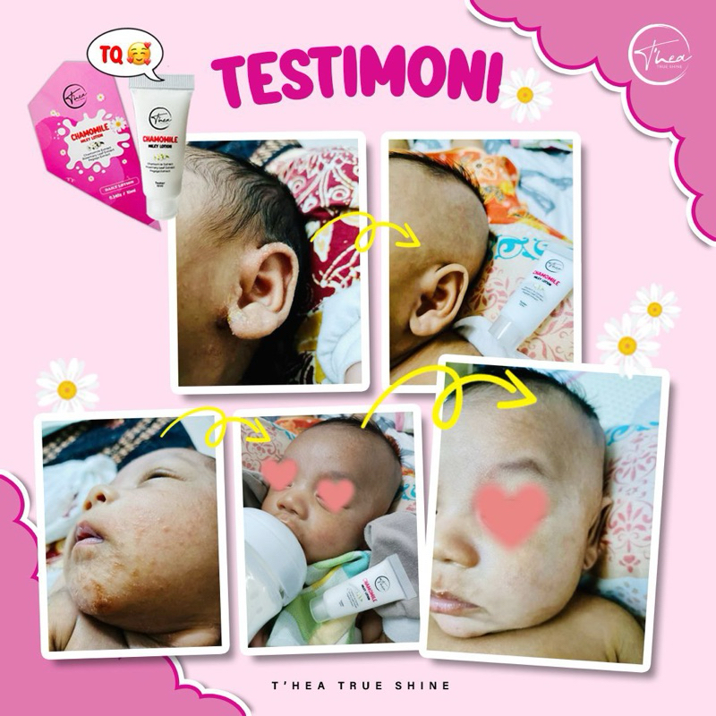 Losyen Thea Snowhitee susu merawat Eczema Kudis Gatal Kurap Ruam panas ...
