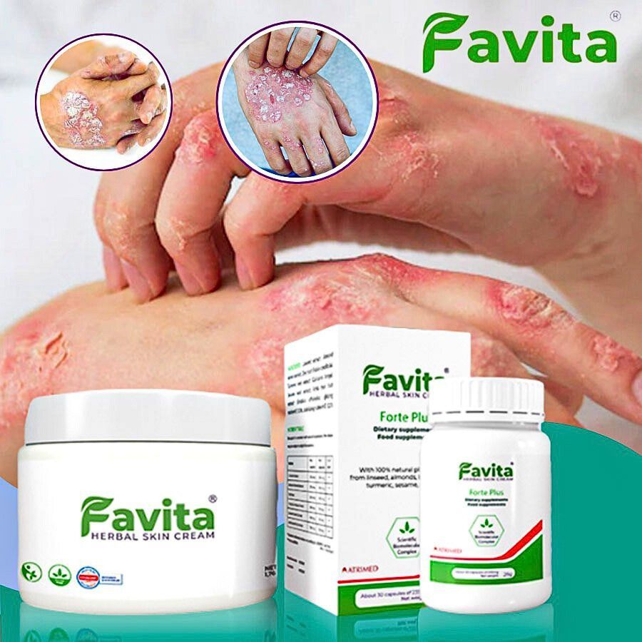 Favita Cream Krim Gatal Kulit Untuk Eczema Dan Psoriasis Dengan Formula ...