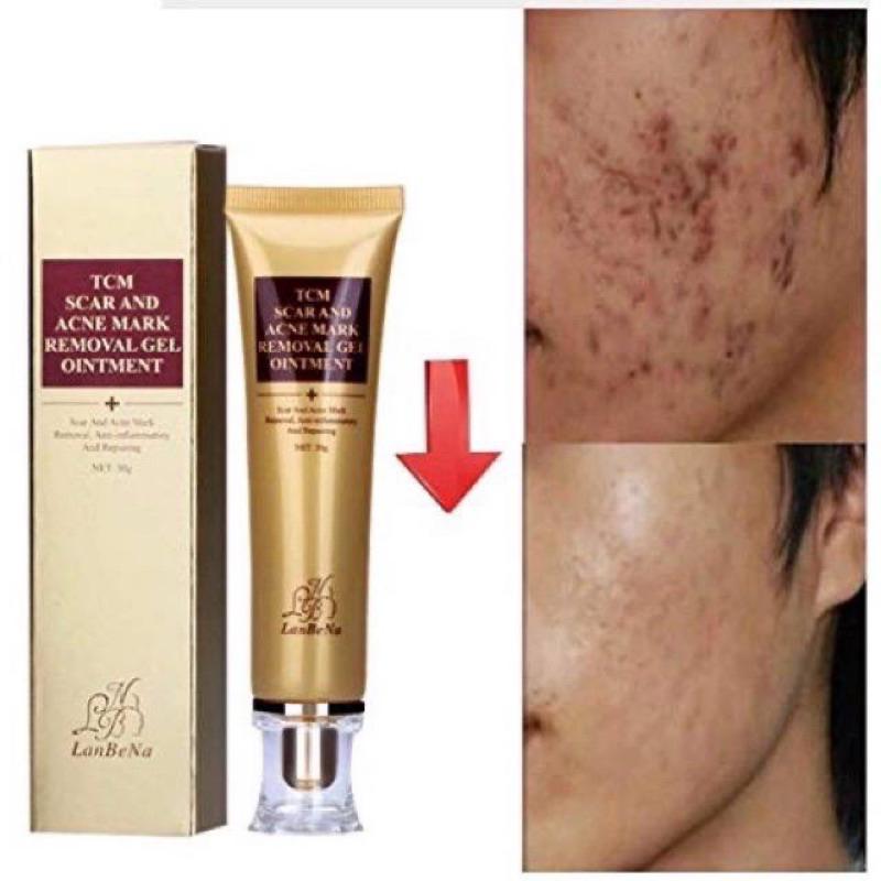 SCAR REPAIR LANBENA CREAM krim penghilang parut lama dan baru selulit ...