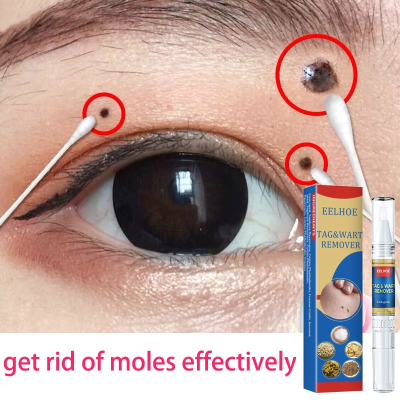 Ubat Buang Kutil ubat ketuat kutil ketuat tahi lalat biji kolestrol ...