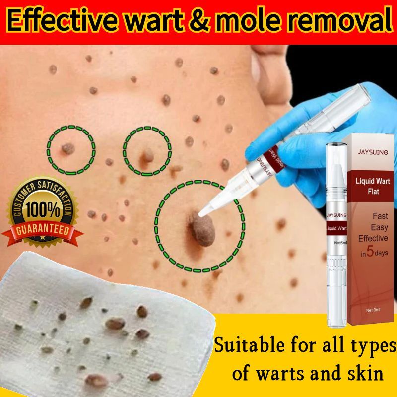 Ubat Ketuat Wart remover Skin tag remover Wart Treatment Liquid Pen ...