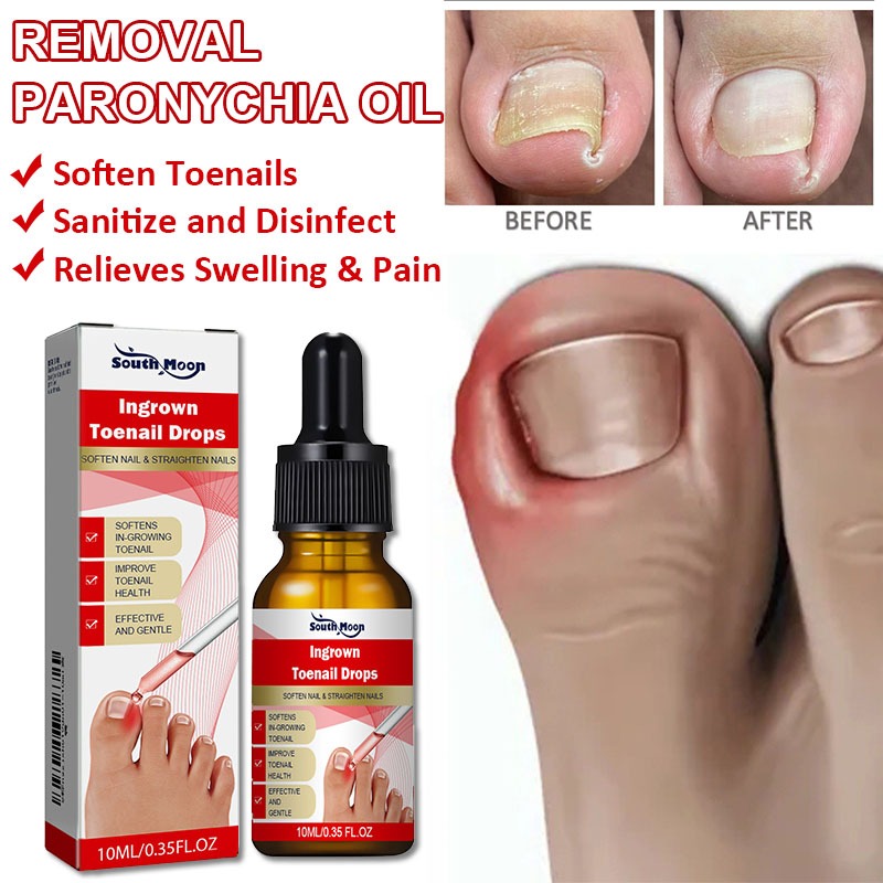 Ingrown Toenail Removal Paronychia Toenailcare Toenail Correction Nail ...
