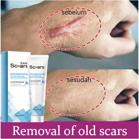 Scar cream scar removal cream krim hilangkan parut hitam hilangkan ...