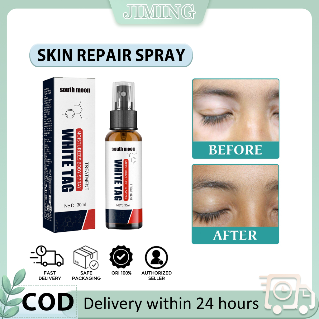 Vitiligo Treatment Spray 30ml White Tag Treatment Remover Skin White ...