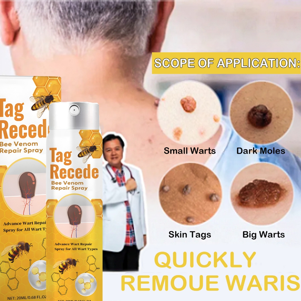 Bee Venom Treatment Spray Wart Removal Spray Skin tag remover Ubat ...