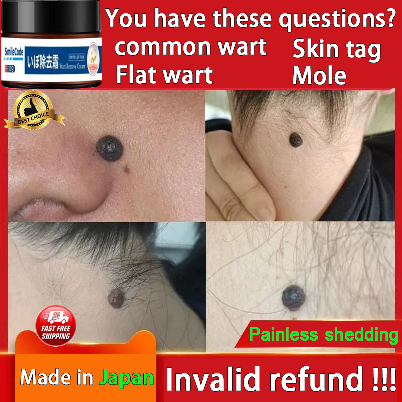 (Japan)Ubat ketuat warts removal cream 30g wart remover skin tag ...