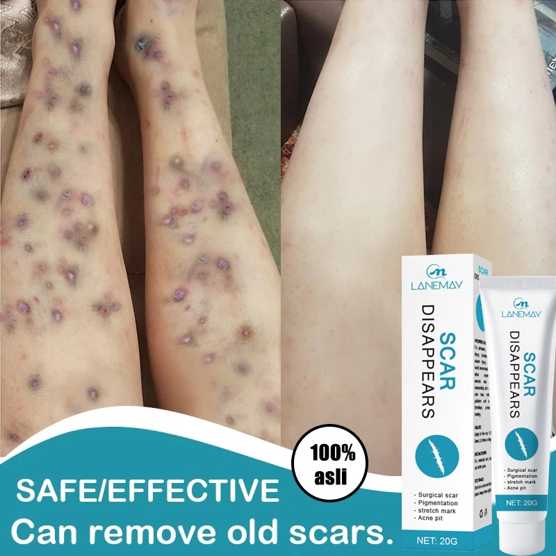 scar removal cream keloid scar remover ubat hilangkan parut ubat parut ...