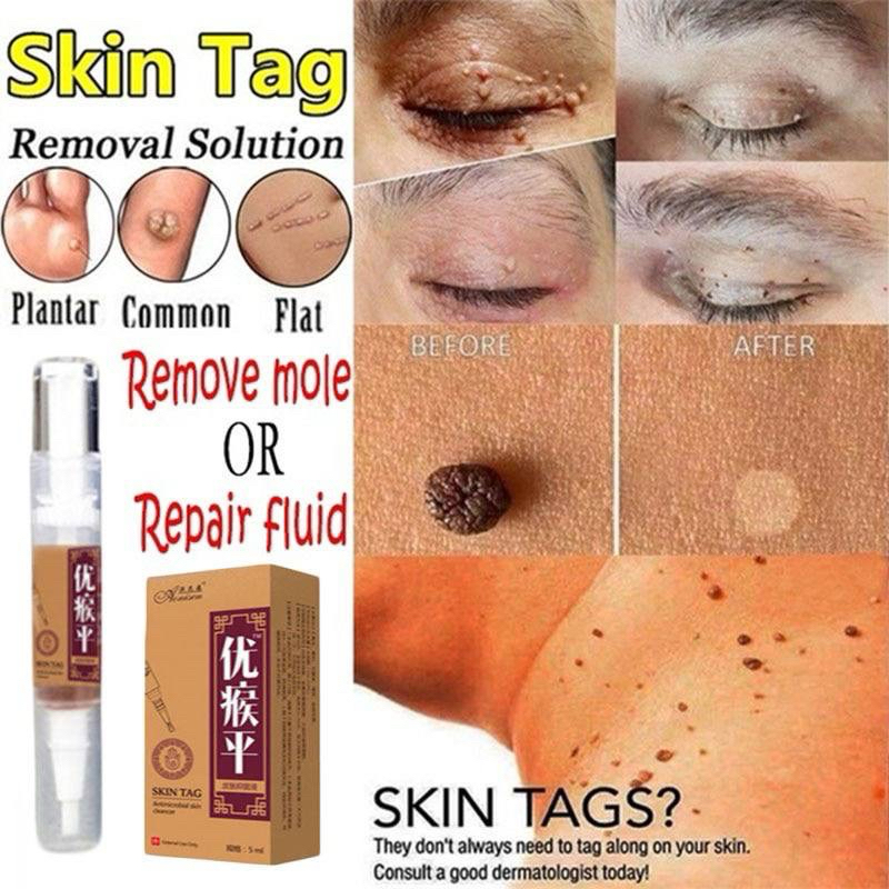 ONISEN SKIN TAG ANTIMICROBIAL SKIN CLEANCER penanggal ketuat kutil tahi ...
