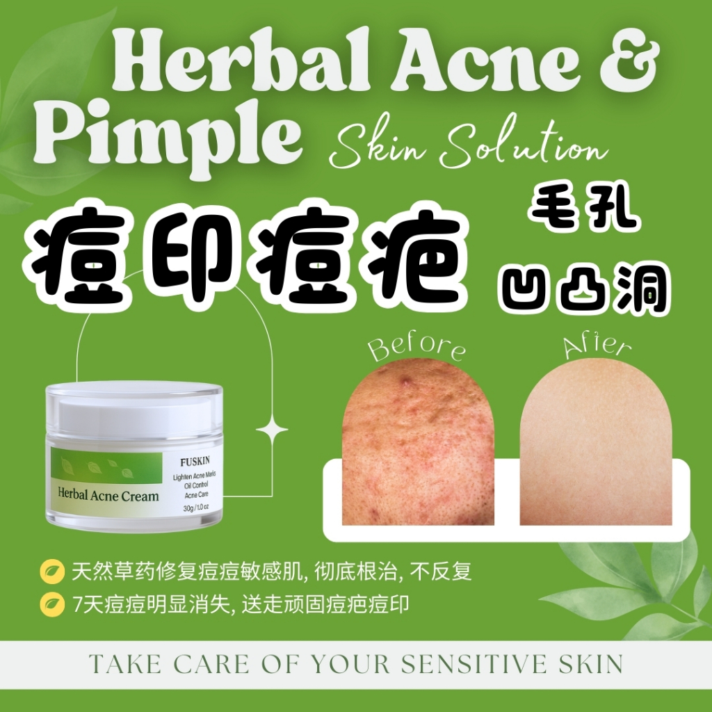 FUSKIN Herbal Acne Pimple Cream “肤” 祛痘膏 痘痘膏 凹凸洞 痘疤痘印 Krim Jerawat Acne ...