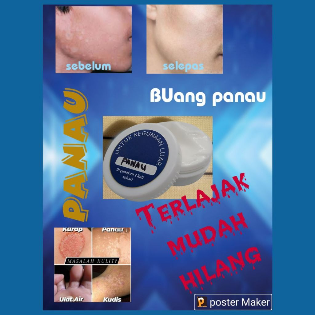 krim panau,hilang panau,hilang kurap,panau lama,panau baru,merawat ...