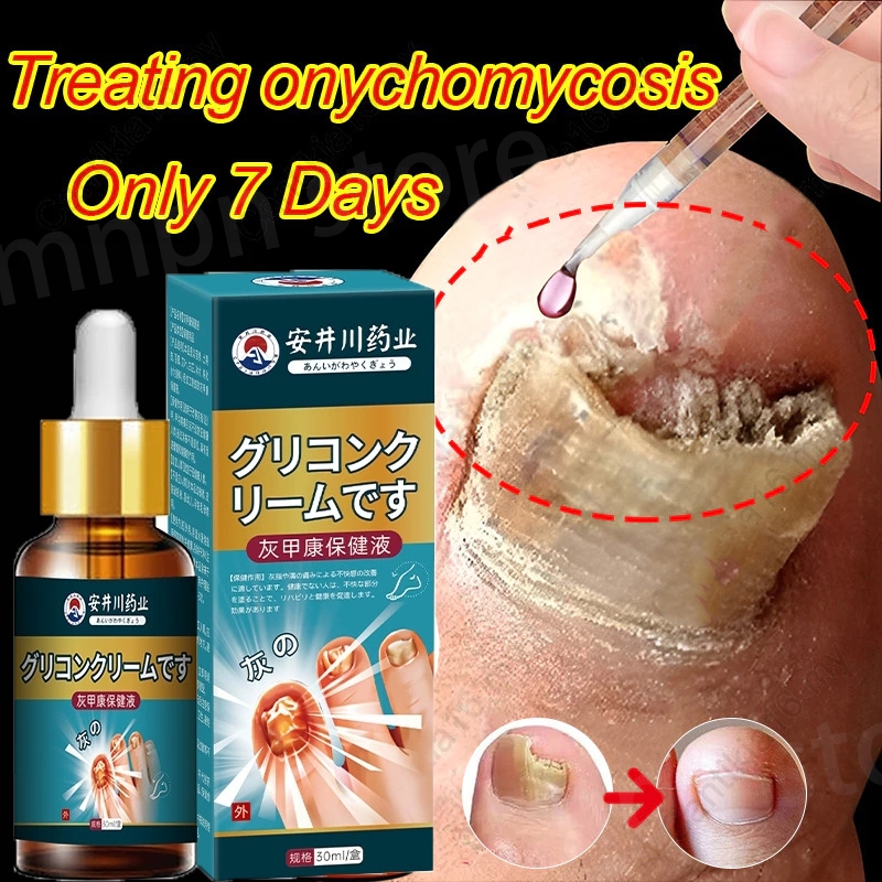 Japan ubat kuku rosak nail fungus treatment ubat kulat kuku ingrown ...