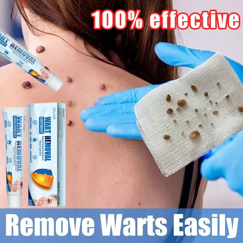 Warts Removal Cream ubat kutil tahi lalat ketuat dan biji kolesterol ...