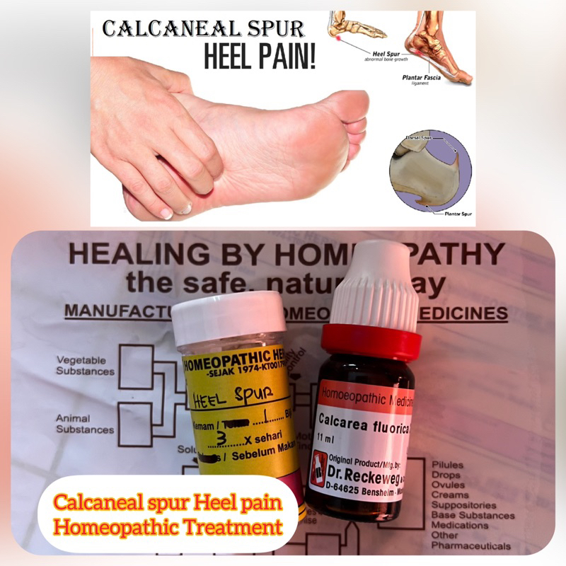 CALCANEAL SPUR HEEL PA!N (homeopathy treatment) | Shopee Malaysia