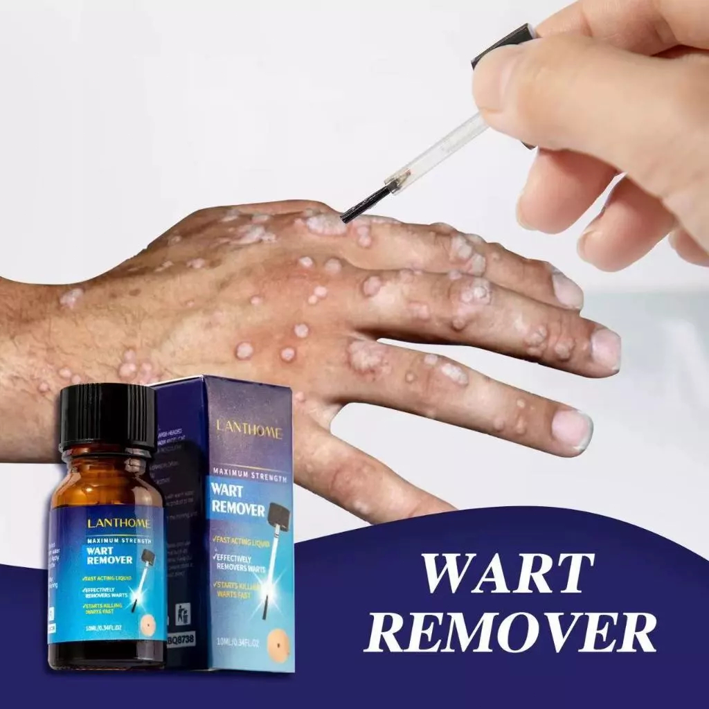 🔥🔥🔥【Buy 2 Get 1 Free】 Ubat ketuat Tahi lalat remover Skin Tag, Mole ...