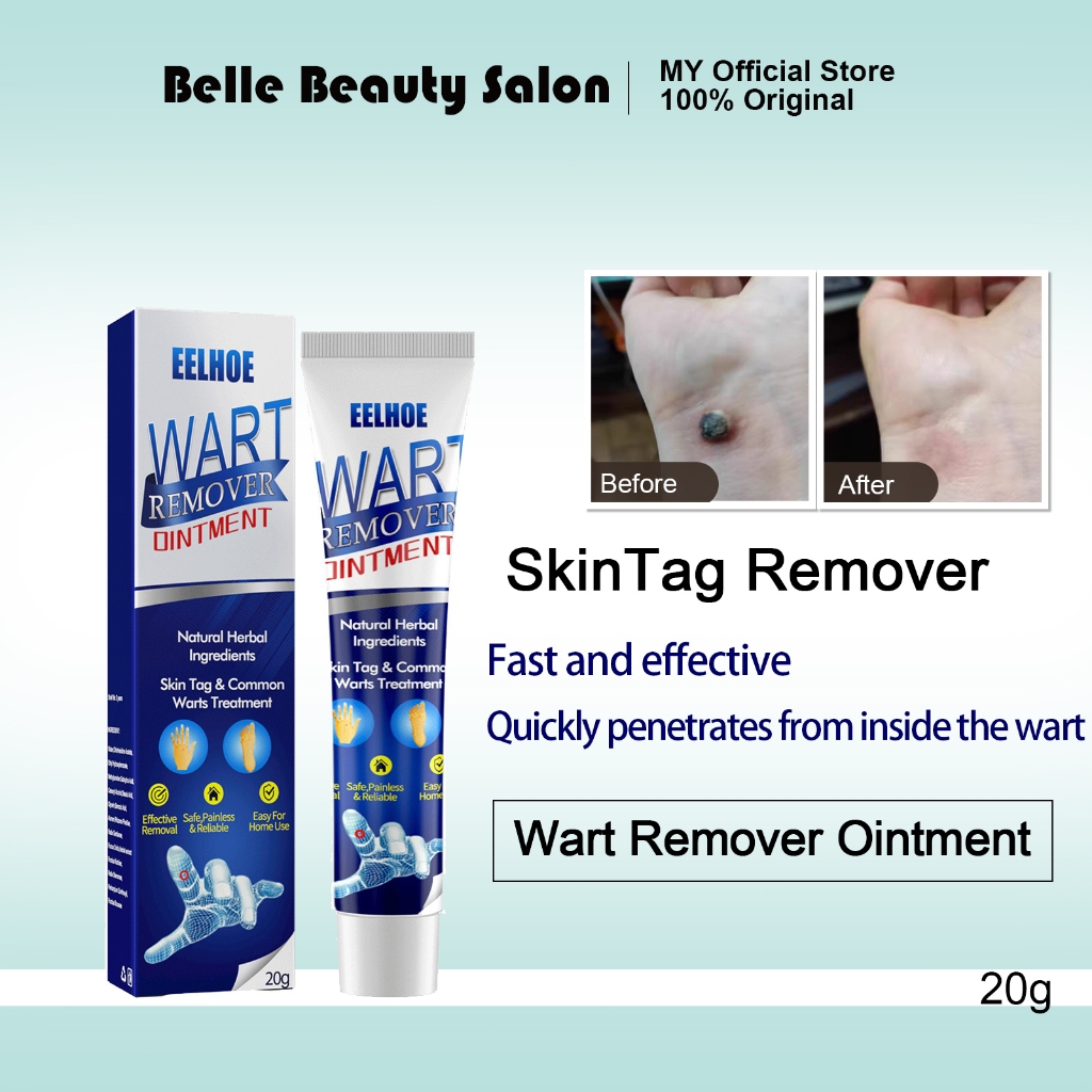Wart Remover Ointment 20g Ketuat remover ubat kutil Warts Removal Cream ...