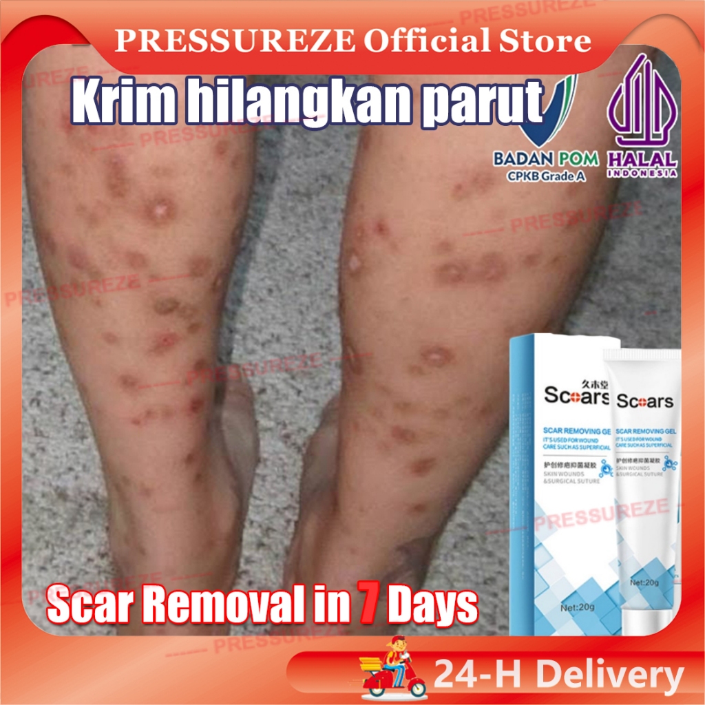 Scar Remover Gel Cream Fade Acne Scars luka lama Hilangkan parut kudis ...
