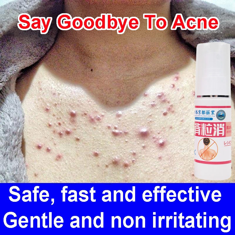 Acne Removal Spray Pimple Treatment Spray whitening body Remove Mites ...