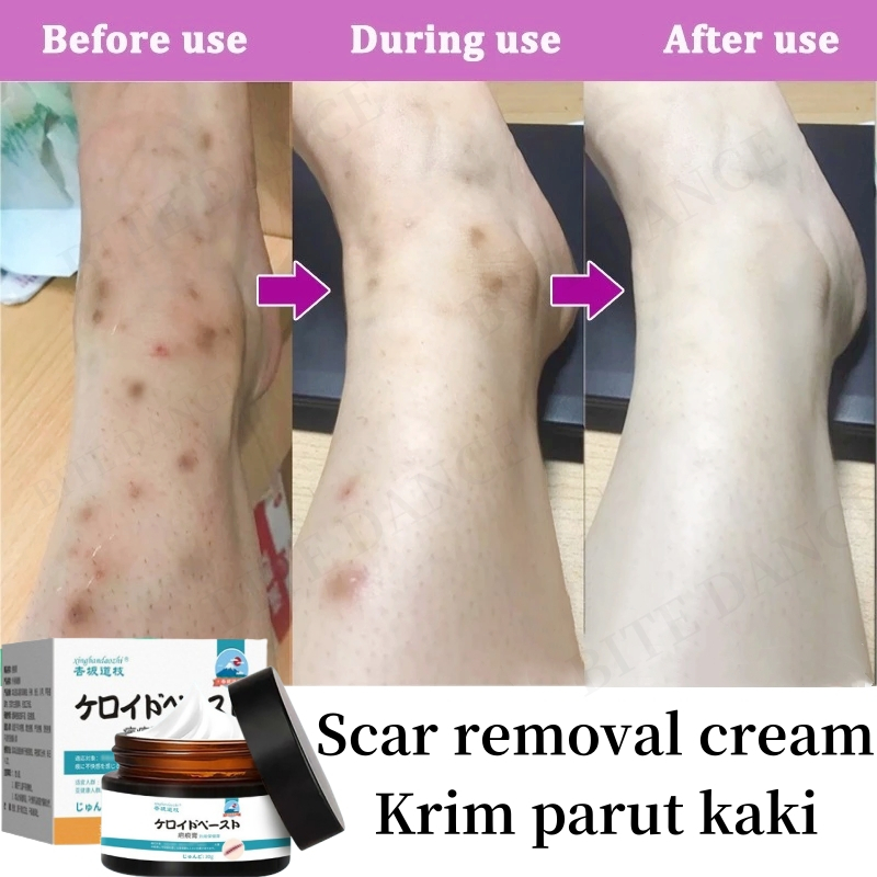 Ubat parut Hilangkan parut hitam Hilangkan parut kaki Menghilangkan ...