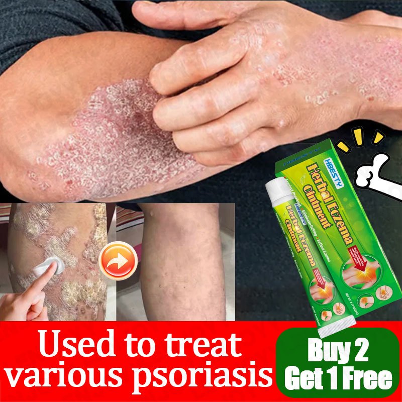 Ubat Kurap Manusia Psoriasis Cream Jock Itch Cream Eczema Cream Krim ...