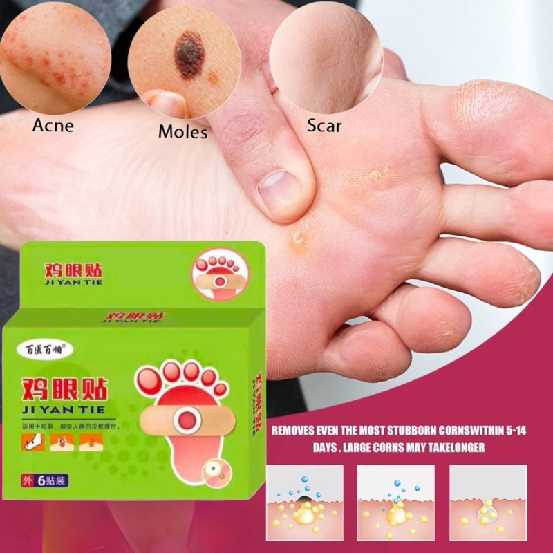 CORN STICKERS JI YAN TIE Plaster penanggal ketuat kutil tahi lalat ...