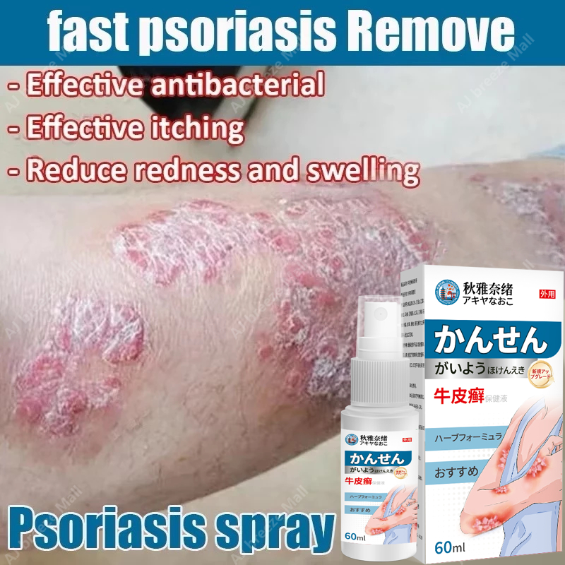 Psoriasis Spray Eczema Relief Ubat Gatal Kulit Ubat Kurap Anti Fungal ...