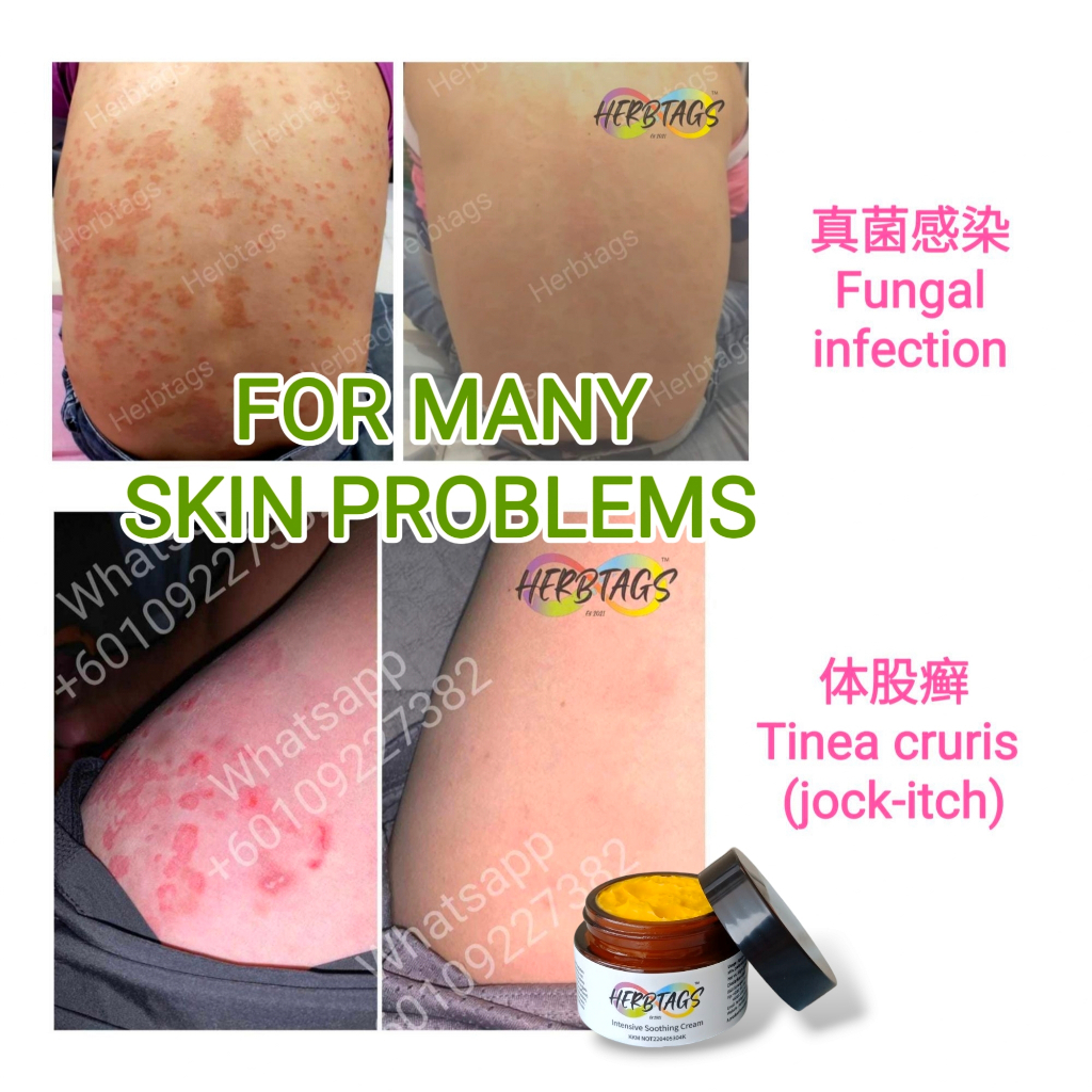 Skin problems ringworm itchy eczema psoriasis urticaria rashes measles ...