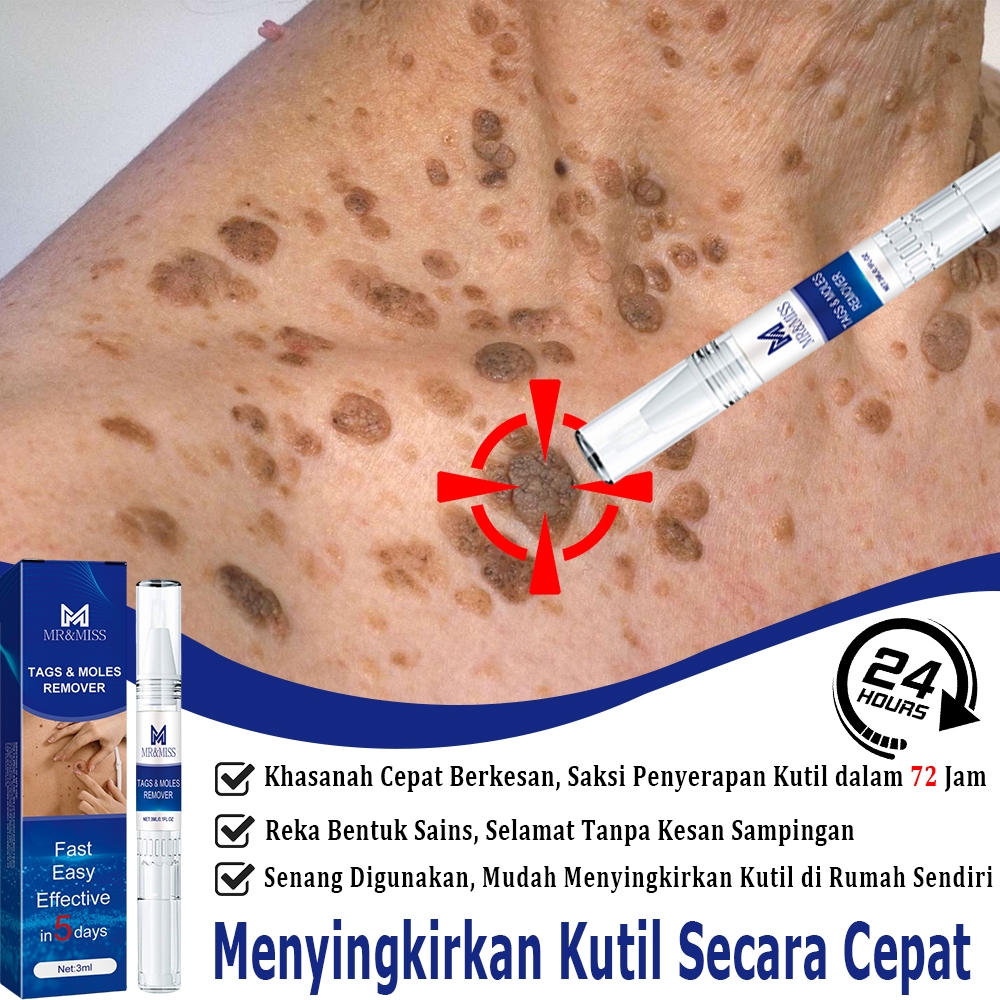 mole remover ubat ketuat skin tag remover tahi lalat remover 3ml Ubat ...