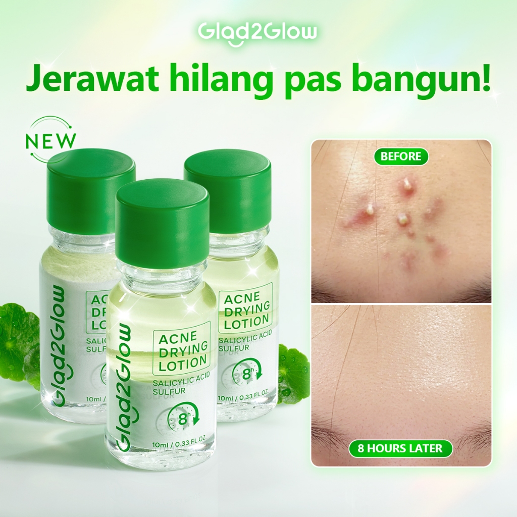 【New Launch】Glad2Glow Acne Drying Lotion 10 ml Calms Acne Treament Scar ...
