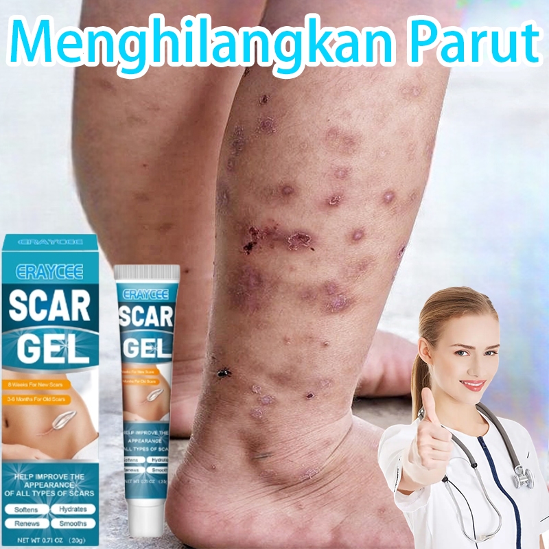 Scar removal cream krim hilangkan parut hitam Hilangkan parut kaki ...
