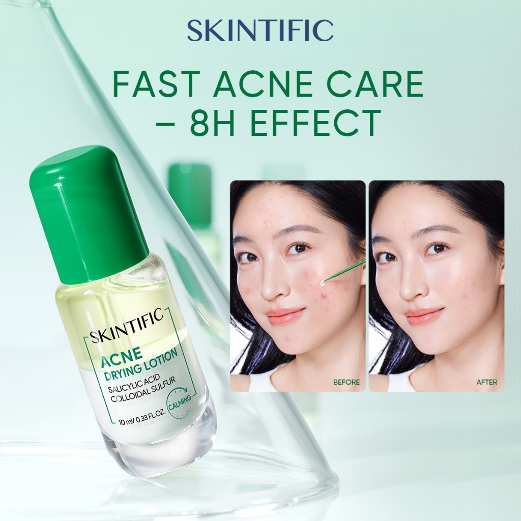 SKINTIFIC Acne Drying Lotion 8H Acne Solution|Niacinamide Fade Acne ...