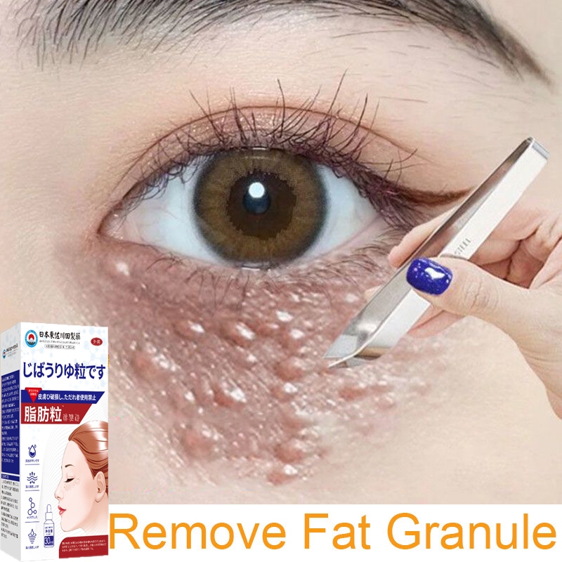 Milia Seed Remover Eye Cream Fat Granule Syringoma Milia Remover Grease ...