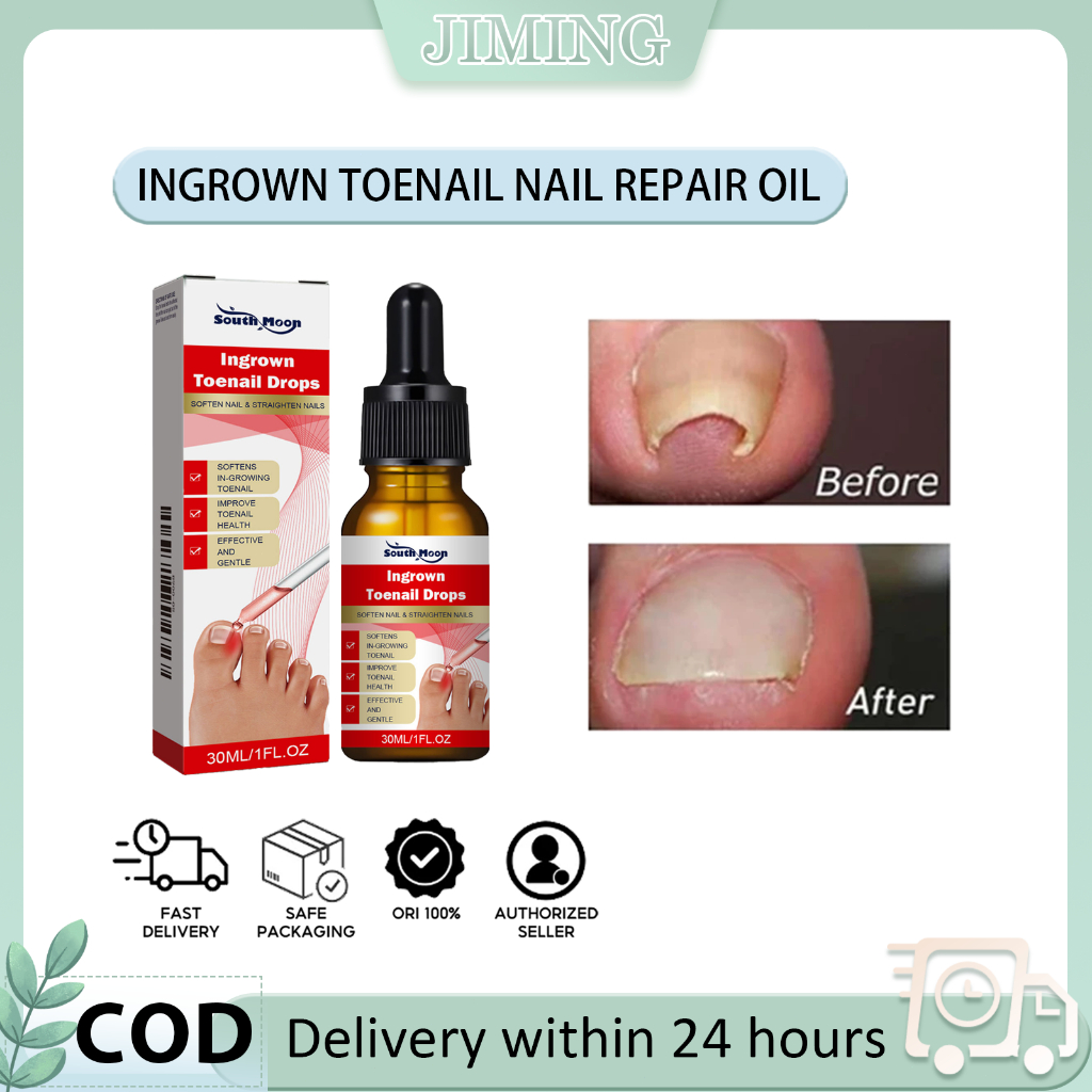 Ingrown Toenail Nail Repair Oil treats ingrown nail fungus ...