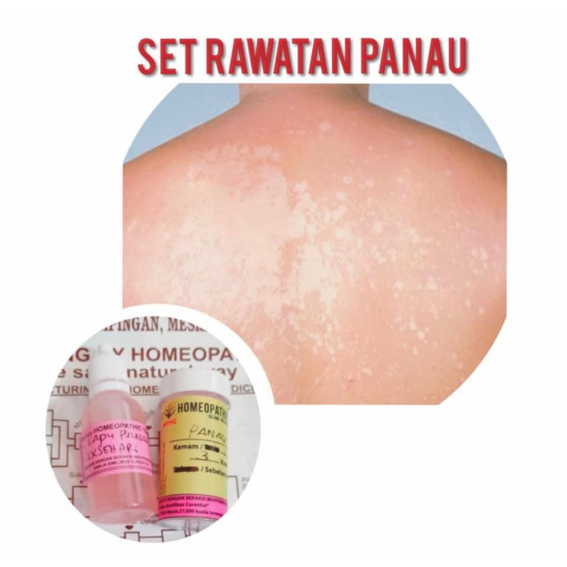 PANAU/BERSIH PANAU (HOMEOPATHY) | Shopee Malaysia