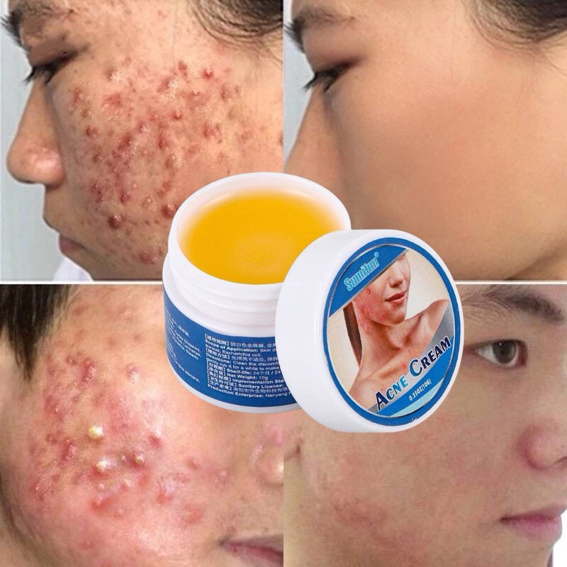 ACNE REMOVER CREAM Krim anti jerawat penjagaan jerawat acne treatment ...