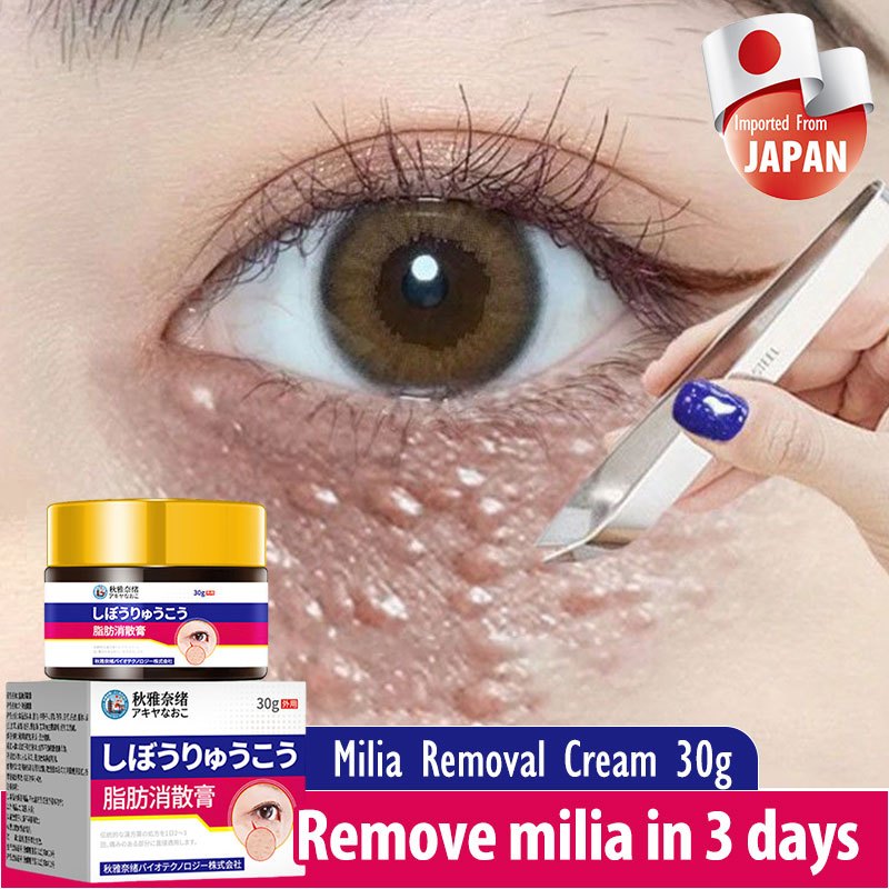 Milia Removal Cream Milia Remover 30g Removes Milia Syringoma ...