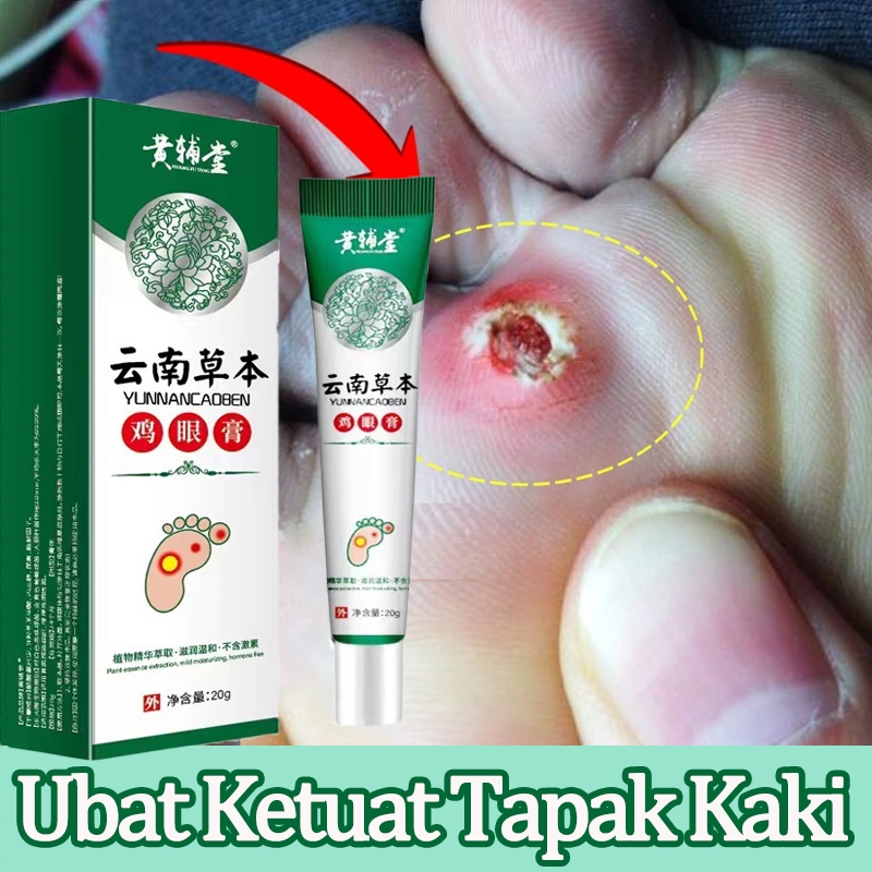 Ubat Ketuat Tapak Kaki corn plaster remover Foot Corn Remover Corn ...