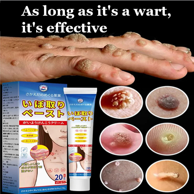Warts cream Genital wart removal cream Wart removal cream ubat buang ...