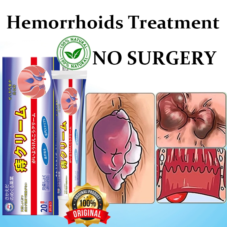 Hemorrhoid cream Ubat Buasir 20g Herba Cina Krim Buasir 100% berkesan relieve itching burning ...