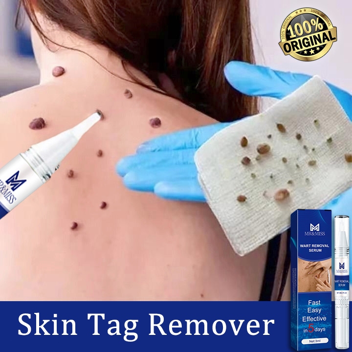 Ubat ketuat Tahi lalat remover skin tag remover wart remover warts ...
