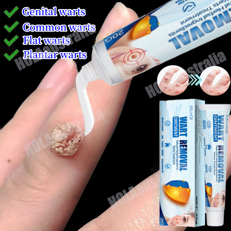 Warts Remover Ointment Ubat buang kutil ketuat tahi lalat biji ...