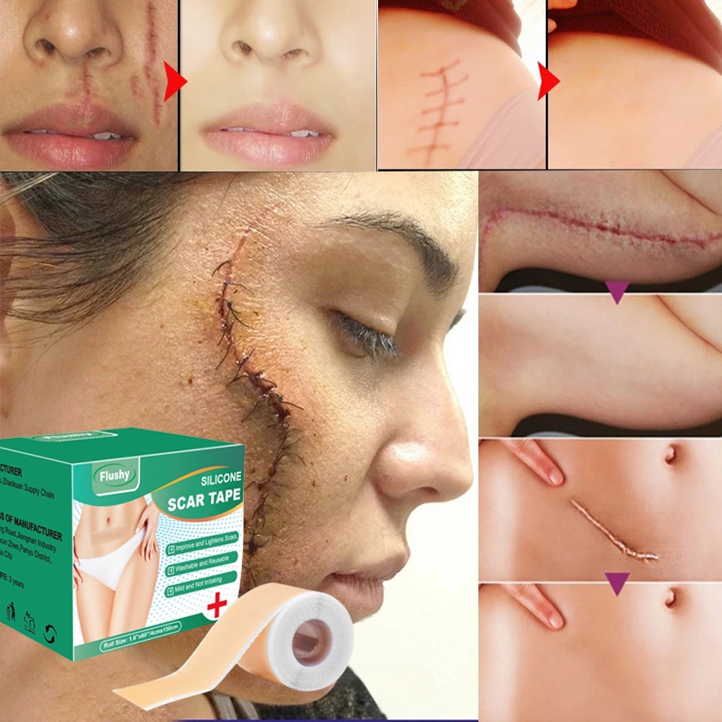 Silicone Scar Sheet Scar reducer Patch Scar post Remove old scar ...