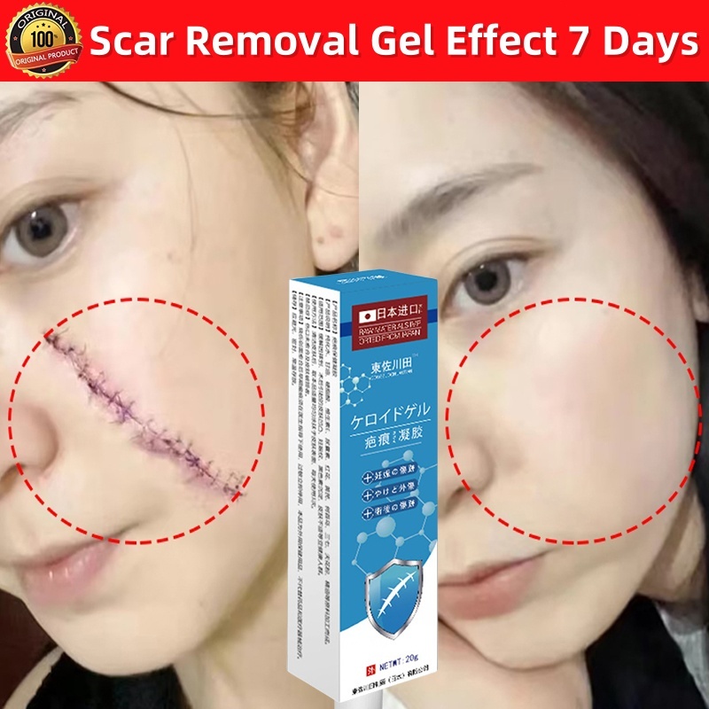 ubat parut Scar Removal Gel Keloid Scar Remover Stretch Marks ...