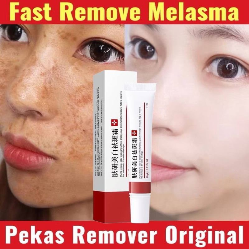 WHITENING FRECKLE CREAM penghilang jeragat bintik hitam melasma pigmen ...