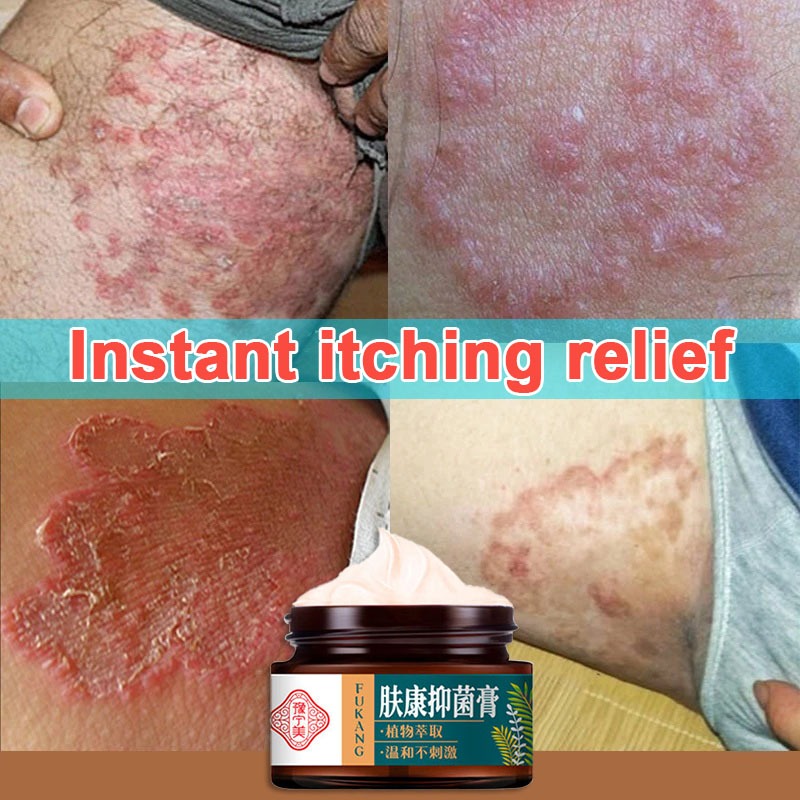 Official Authentic Itching cream Krim gatal Psoriasis Eczema cream 百草抑菌止癢膏30g Antibacterial ...
